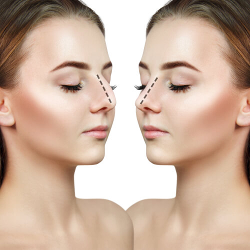 How To Get The Perfect Nose Job: What Should Be Done?