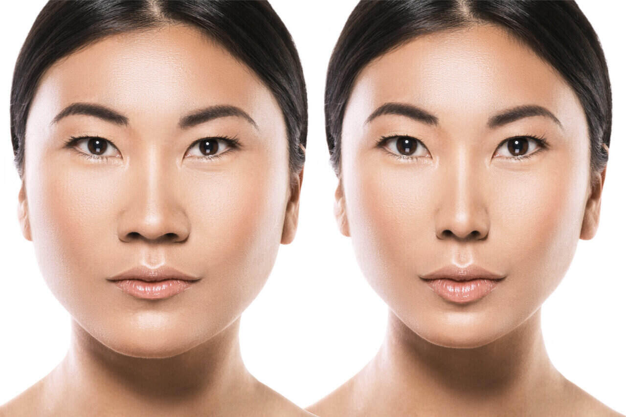 Asian Rhinoplasty: What's In Store In This Variation Of Surgery?